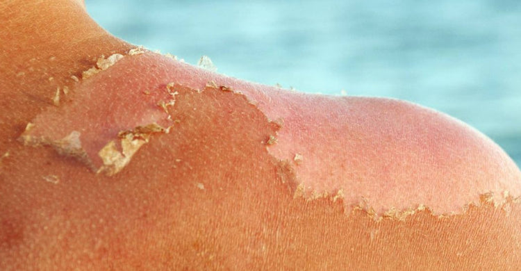 QUEMADURAS DE SOL ¿QUÉ HACER? – Biolife