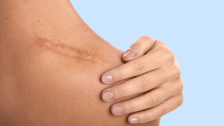 Cómo prevenir o tratar una cicatriz por cirugía o trauma – Biolife