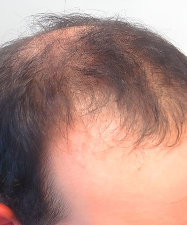 Shampoo Anticaída y Rápido Crecimiento – Biolife